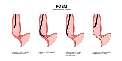 Premium Vector Peroral Endoscopic Myotomy Poem Minimally Invasive