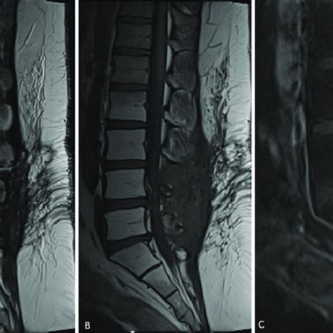 Postoperative Mri Of The Lumbar Spine Sagittal T2 Weighted A Download Scientific Diagram