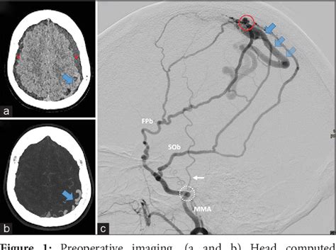 Figure 1 From The Dural Vascular Plexus In Subdural Hematoma Illustration Through A Case Of
