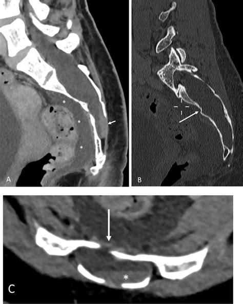 Ct Scan Shows A Hypoattenuating Image Suggestive Of A Sacral Cyst