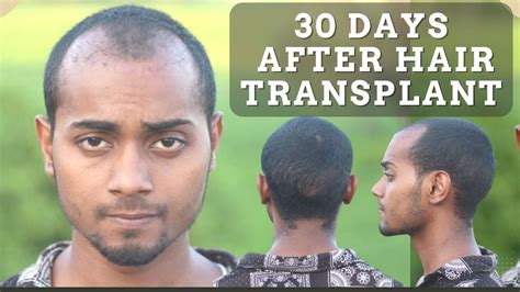 Shedding Phase 1 Month Condition After Hair Transplant Hair