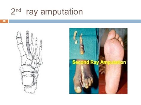 Prosthetic Management Of Symes And Partial Foot Amputation
