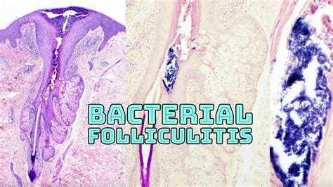 Bacterial Folliculitis Under Microscope Inflamed Hair Follicle W Gram