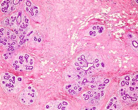 Human Breast Gland Secretory Units Adenosis Stock Image Image Of
