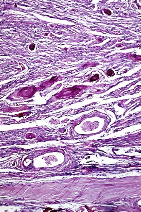 Meningioma Tumour Light Micrograph Stock Image C0055031 Science