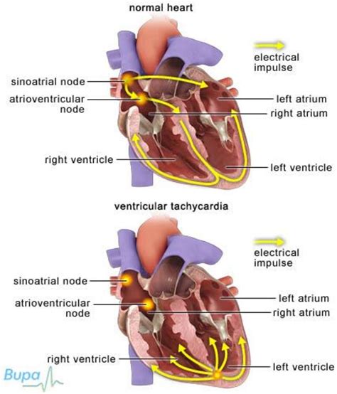 Heart Condition Long Qt Syndrome Hubpages