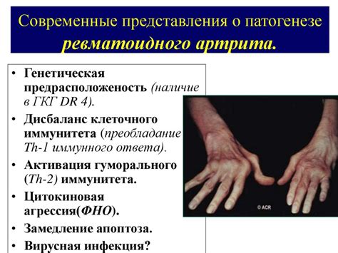 Ревматоидный артрит презентация онлайн