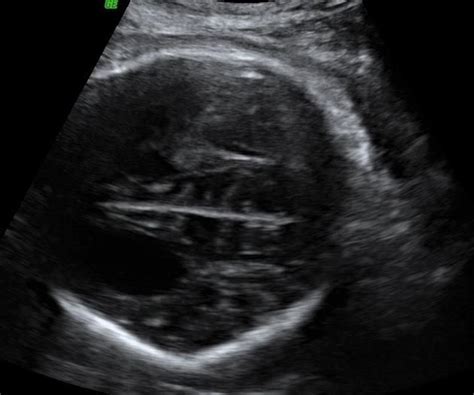 Agenesis Of Corpus Callosum Ultrasound