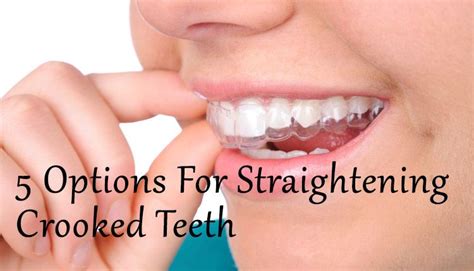 How To Get Rid Of White Spots On Teeth With Braces Trending Now