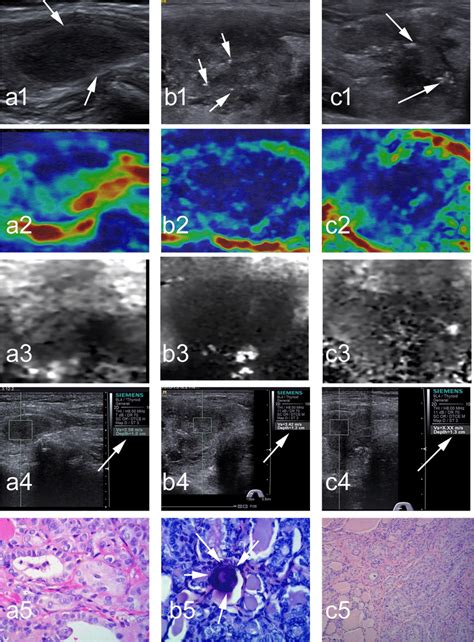 Representative Images And Histology Of Non Calcified Micro Calcified