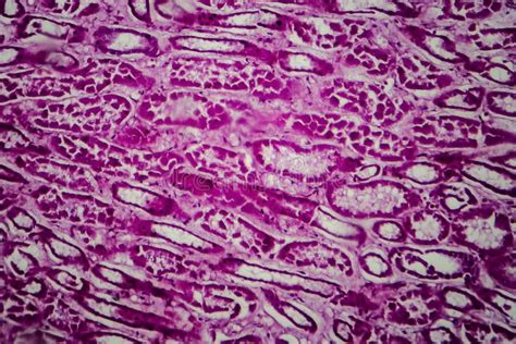 Diffuse Sclerosing Glomerulonephritis Stock Image Image Of Microscope