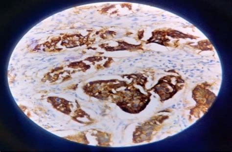 Ich Of Invasive Duct Carcinoma Her 2neu Positive 40x Download
