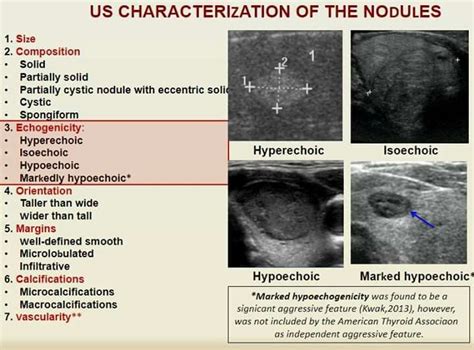 Sponorm Thyroid Nodule My Buzz Look