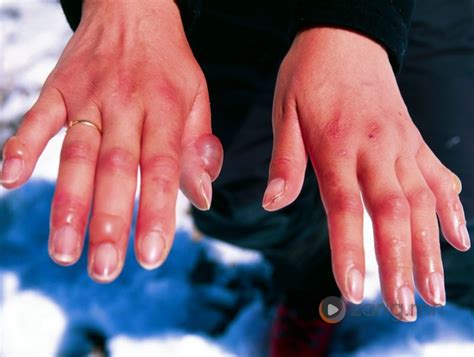 НЭМҮТ Осголт хөлдөлтийн үед үзүүлэх анхны тусламж