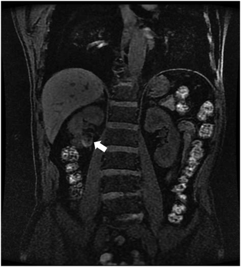 At 8 Months After The Embolization Procedure Contrast Enhanced Download Scientific Diagram