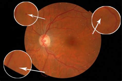figure 2 from microaneurysm detection in retinal images using an