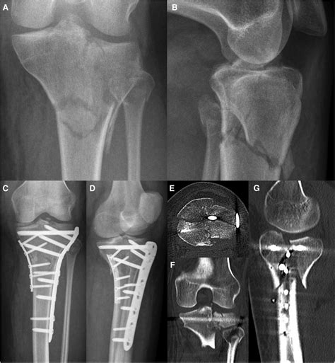Frontiers Current Concepts Review Management Of Proximal Tibial Fractures