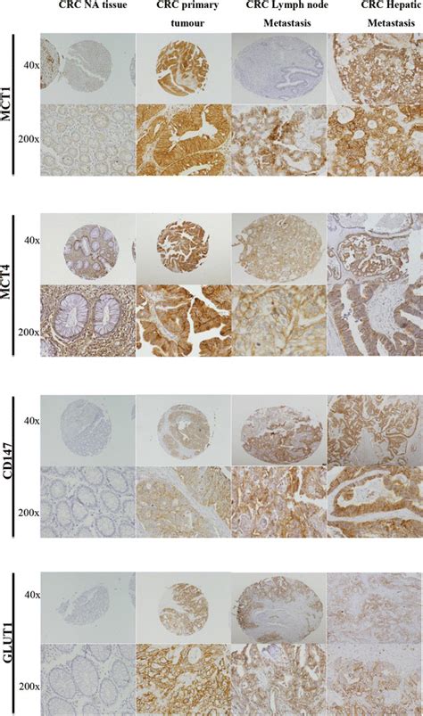 Representative Immunohistochemical Expression Of Proteins In CRC NA