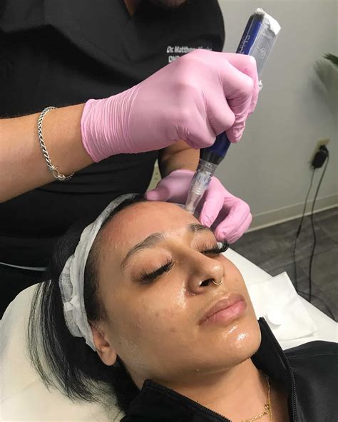 Skinpen Microneedling Institute For Laser Medicine