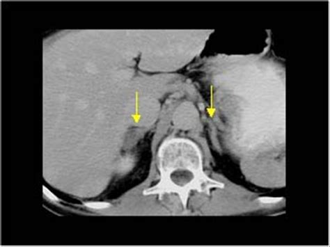 Abdomen And Retroperitoneum 1 10 Adrenal Glands Case 1 10 2 Adrenal