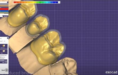 Digital Design In EXOCAD Online Dental Library