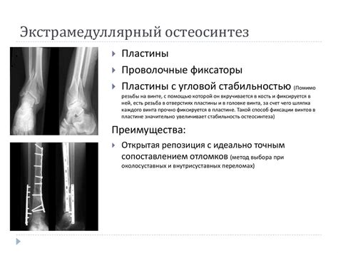 Переломы Вывихи Online Presentation