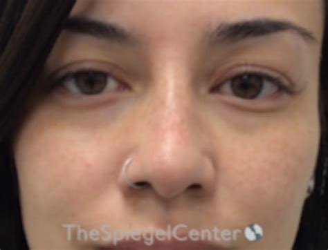 Patient 157140811 Non Surgical Rhinoplasty Nose Filler Before