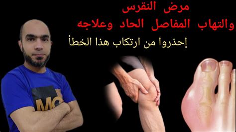علاج النقرس النهائي Gout وإلتهاب المفاصل اليوريك أسيد خطأ شائع د يوسف