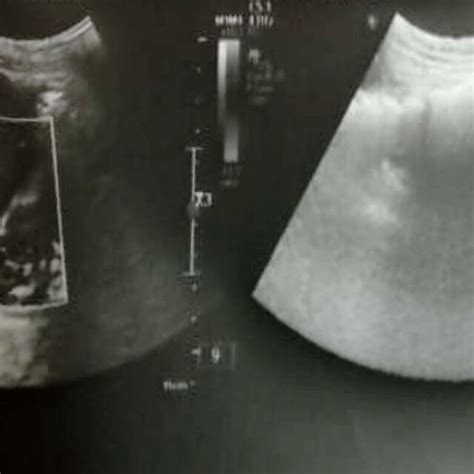 Ultrasonogram Showing Hepatosplenomegaly Download Scientific Diagram