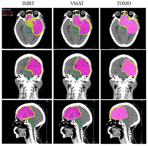 The 4th Patients Dose Distributions On Imrt Vmat And Tomo