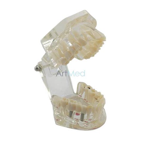 Modelo Dentário Adulto Implantes Artmed Dotamed São João