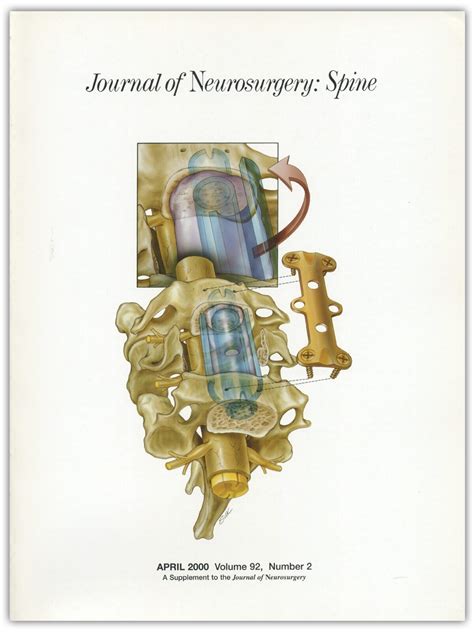 Pathoanatomy Of Clinical Findings In Patients With Sciatica A Magnetic