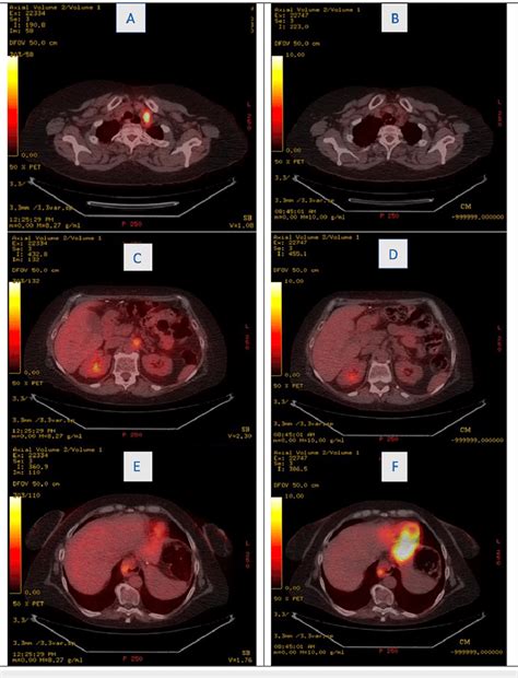 A And B Interval Resolution Of Supraclavicular Lymph Node In The Neck Download Scientific