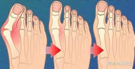 牛江红解说拇外翻的病理性原因 知乎