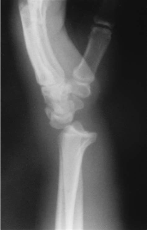 Radiocarpal Fracture Dislocation Hand Orthobullets