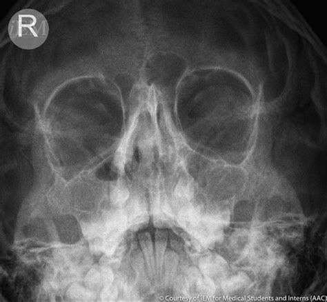 Sinusitis International Emergency Medicine Education Project