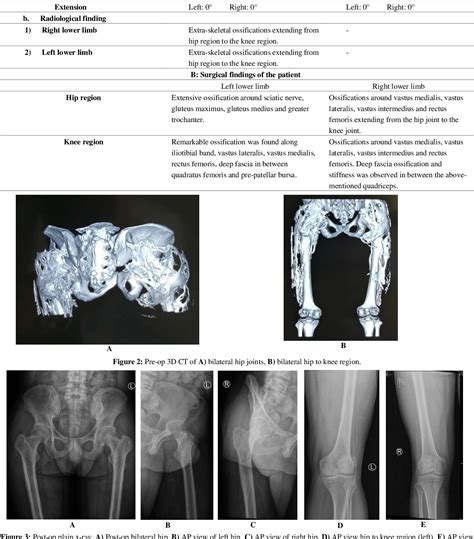 Figure 1 From Extensive Heterotopic Ossification Of Bilateral Hip And