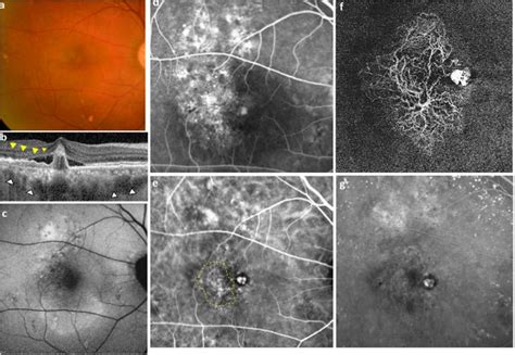 Ophthopedia On Linkedin Macular Neovascularization And Polypoidal