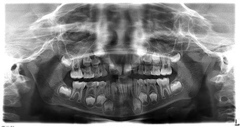 Fusion Teeth Radiograph