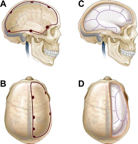 Wartime Decompressive Craniectomy Technique And Lessons Learned In