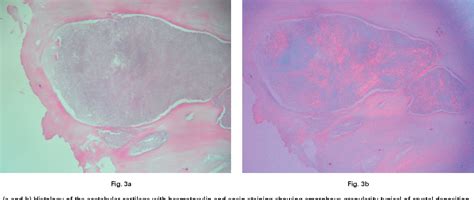 Figure 1 From Isolated Pseudogout Diagnosed On Hip Arthroscopy