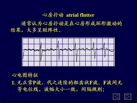 每個醫生都應該學習一下，心電圖學教學ppt（彩圖完整版） 每日頭條