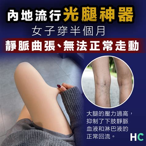 【靜脈曲張】內地流行「光腿神器」女子穿半個月出現水腫、無法正常走動 新浪香港