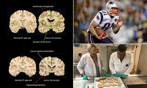 Aaron Hernandez Cte Brain Scan