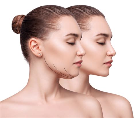 Crafting Confidence A Deep Dive Into Voice Feminization Surgery