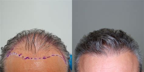 Hair transplant before and after Instituto Médico del Prado