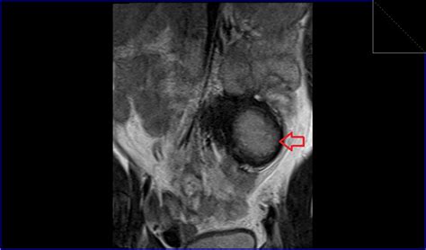 Retroperitoneal Desmoid Mri Radiology Article On Retroperitoneal Desmoid