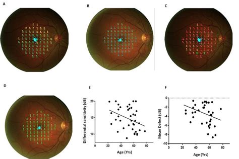 Fundus Perimetry In Patients With Psoriatic Arthritis Sine Psoriasis