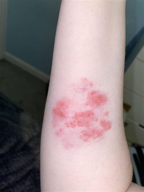 Infected Skin Condition Keeps Coming Back After Antibiotics 19 Yo