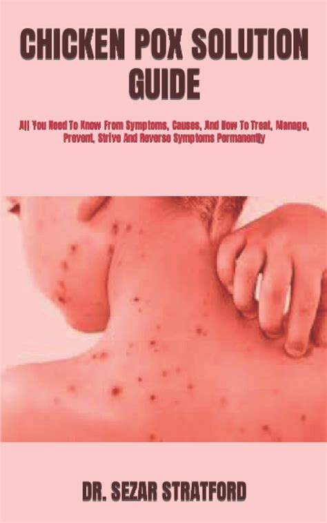 Buy Chicken Pox Solution Guide All You Need To Know From Symptoms